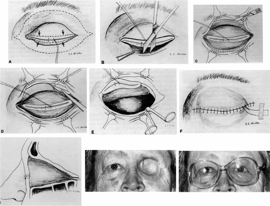 Exenteration - EyeWiki