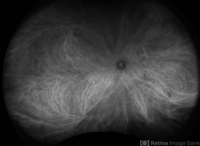 Indocyanine Green Angiography - EyeWiki