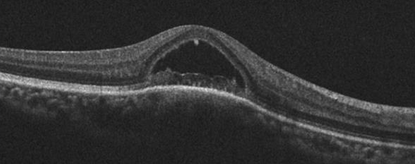 Bacillary Layer Detachment in Retina - EyeWiki