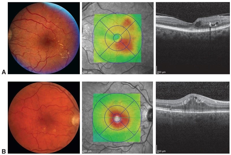 Diabetic Macular Edema - EyeWiki
