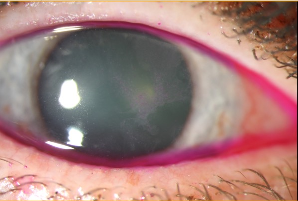 Ocular Surface Squamous Neoplasia - EyeWiki