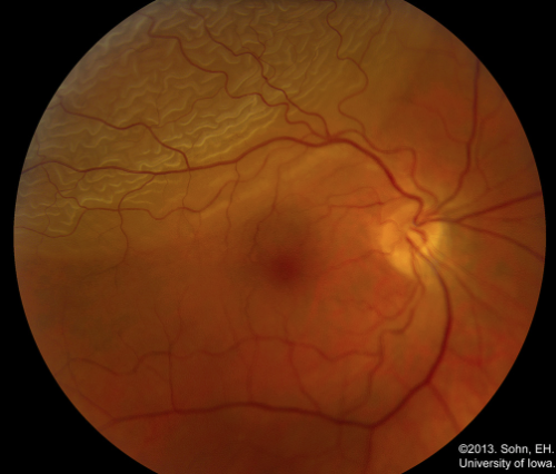 History of Retinal Detachment Surgery - EyeWiki