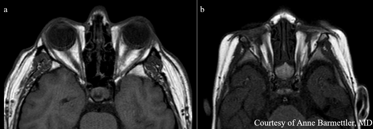 Anophthalmia - EyeWiki