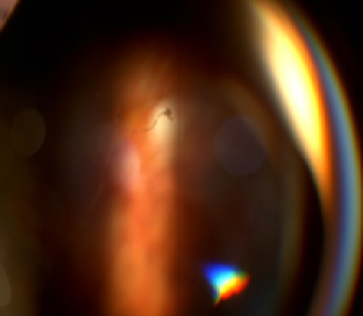 Posterior Vitreous Detachment - EyeWiki