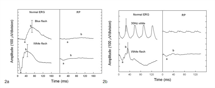 Retinitis Pigmentosa - EyeWiki
