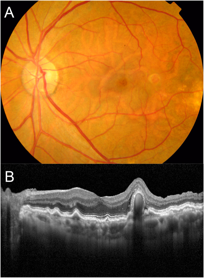 Choroidal Vascular Anomalies: Posterior Vortex Veins, Choroidal ...