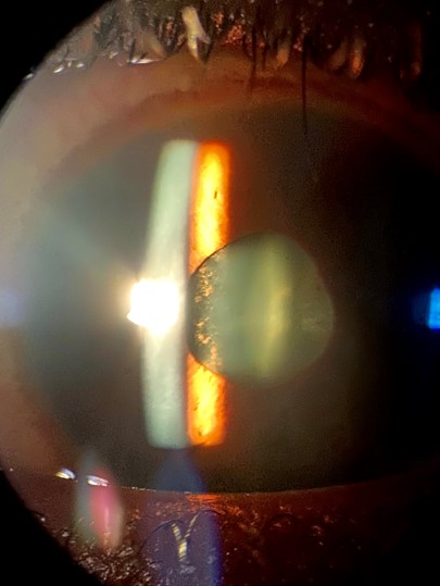 Tattoo-associated Uveitis - EyeWiki