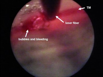 Laser Trabeculotomy in Glaucoma - EyeWiki
