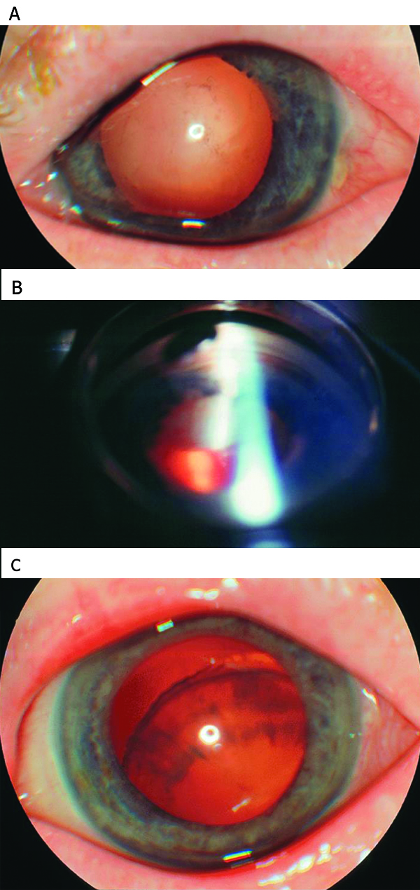 Capsular Support Devices - EyeWiki