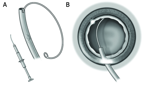 Capsular Support Devices - EyeWiki