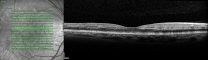 Paracentral Acute Middle Maculopathy - EyeWiki