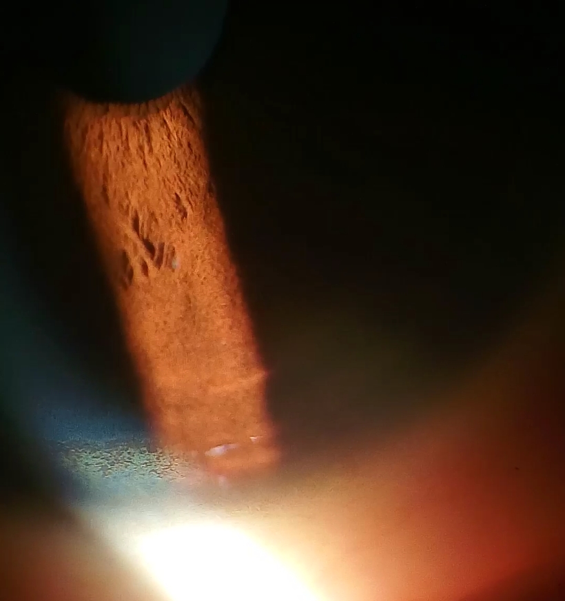 Wilson's Disease/Kayser Fleischer Ring - EyeWiki