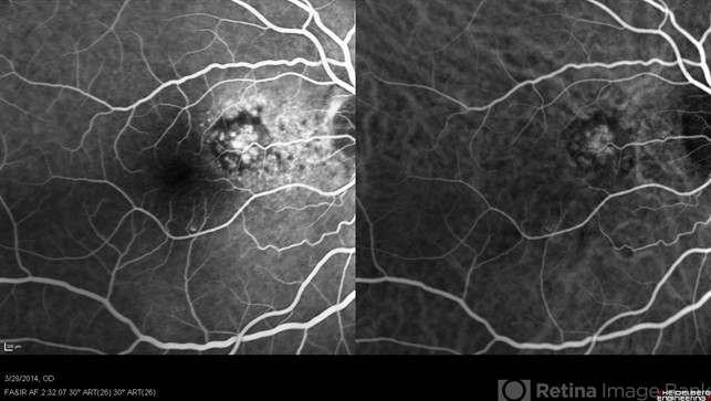 Indocyanine Green Angiography - EyeWiki
