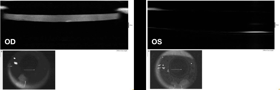 Capsular Bag Distension Syndrome - EyeWiki