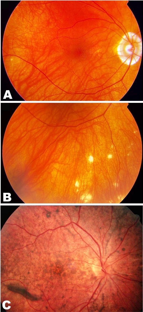 Color Fundus Photography Interpretation of Ophthalmic Findings - EyeWiki