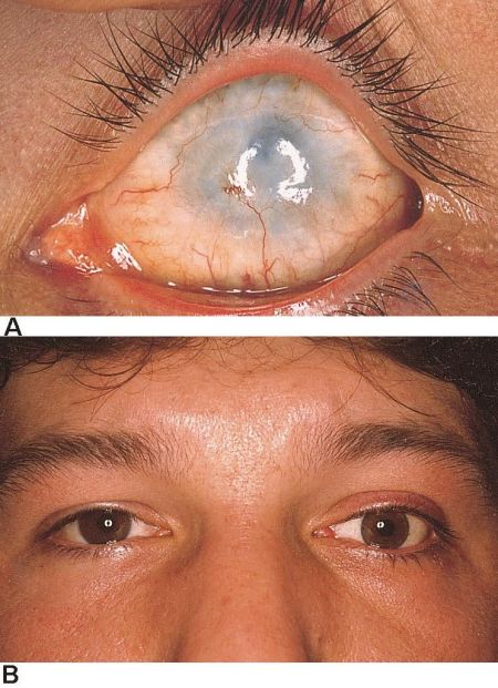 Ocular Prostheses, Scleral Shells, and Conformers - EyeWiki