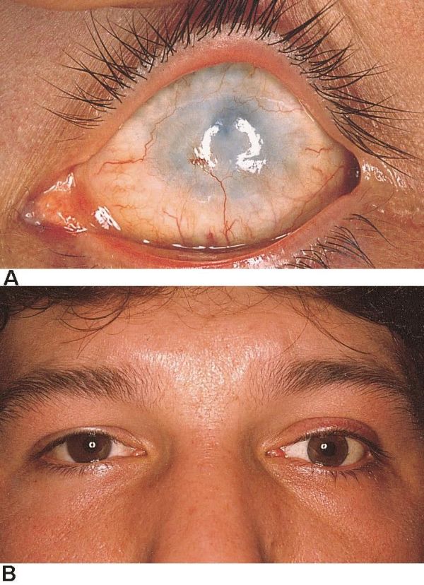 Ocular Prostheses, Scleral Shells, and Conformers - EyeWiki