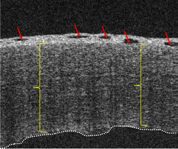 Pseudophakic Bullous Keratopathy - EyeWiki