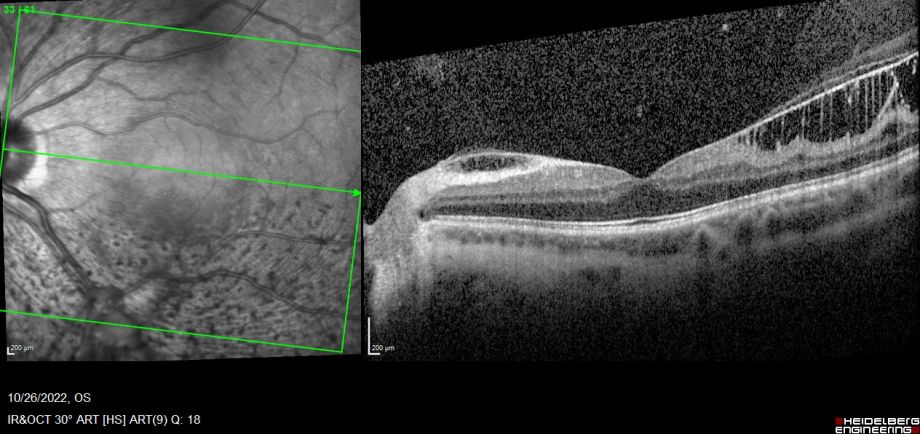 Internal Limiting Membrane Dystrophy (ILMD) - EyeWiki