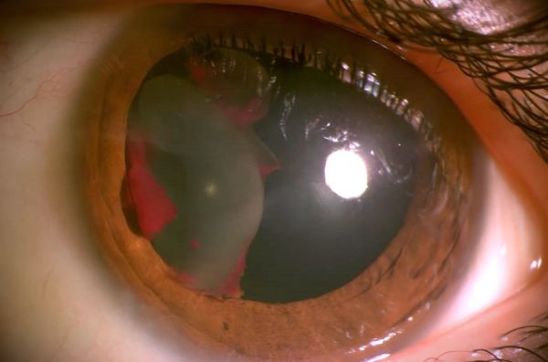 Traumatic Lens Dislocation - EyeWiki
