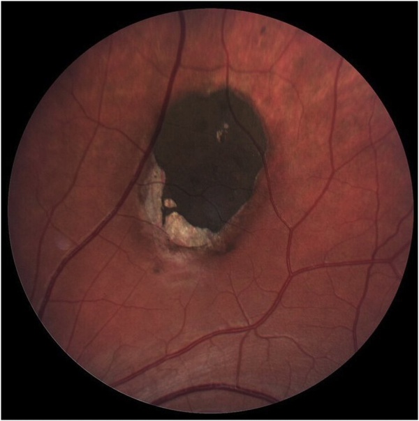 Congenital Hypertrophy of the Retinal Pigment Epithelium - EyeWiki