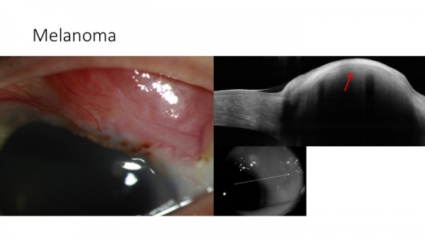 Anterior Segment Optical Coherence Tomography For Various Ocular