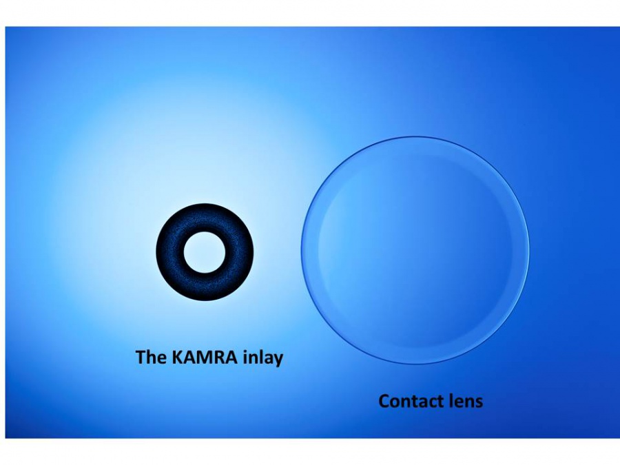 Corneal Inlays - EyeWiki