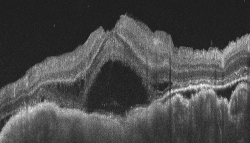 Bacillary Layer Detachment in Retina - EyeWiki