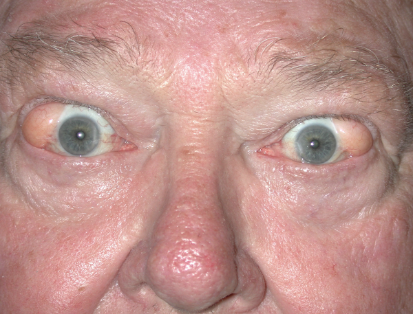 Orbital Lipodermoid - EyeWiki