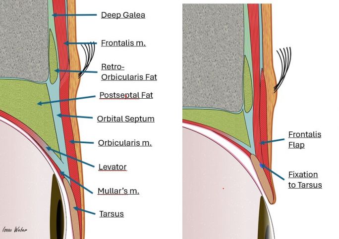 Frontalis Muscle Advancement - EyeWiki