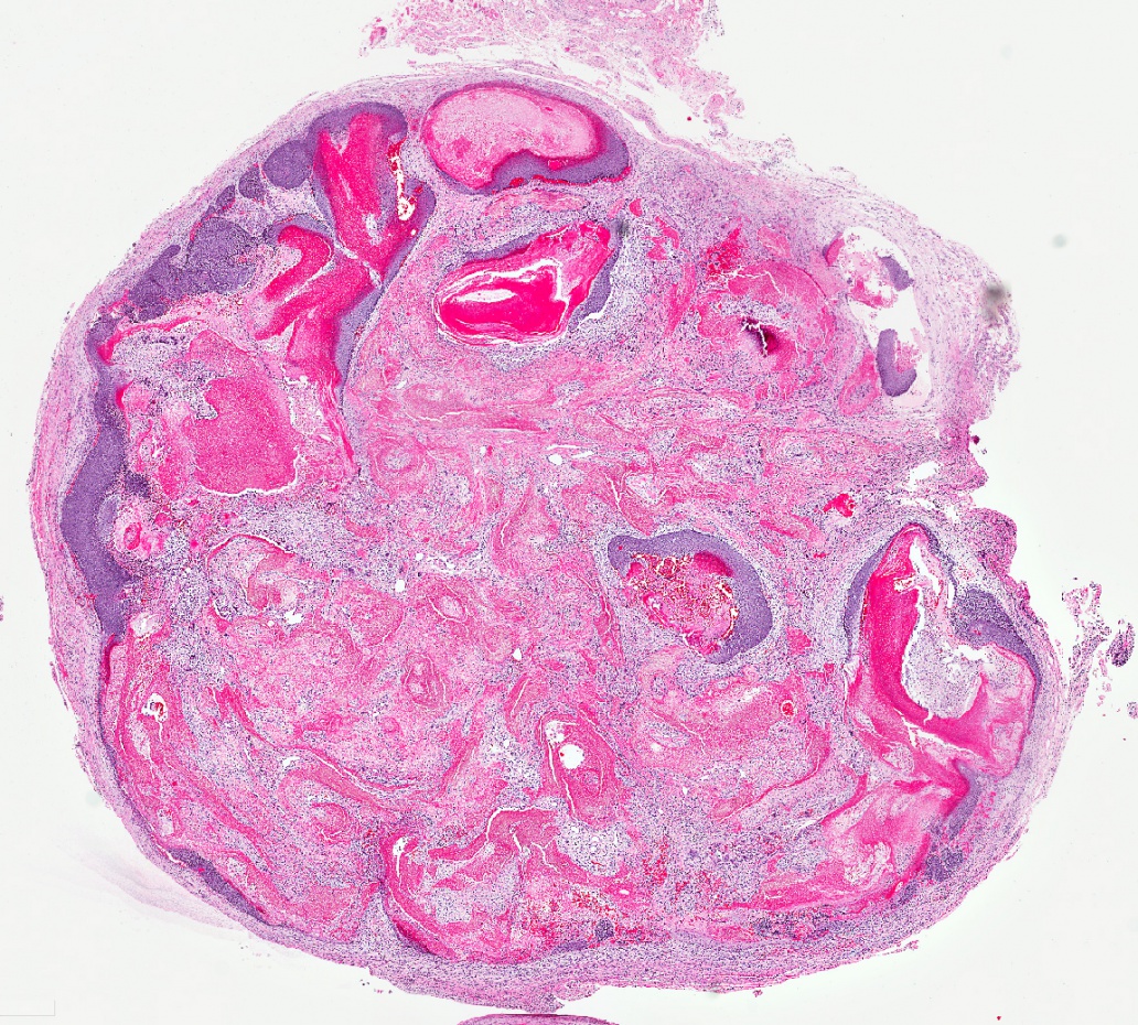 Pilomatrixoma - EyeWiki