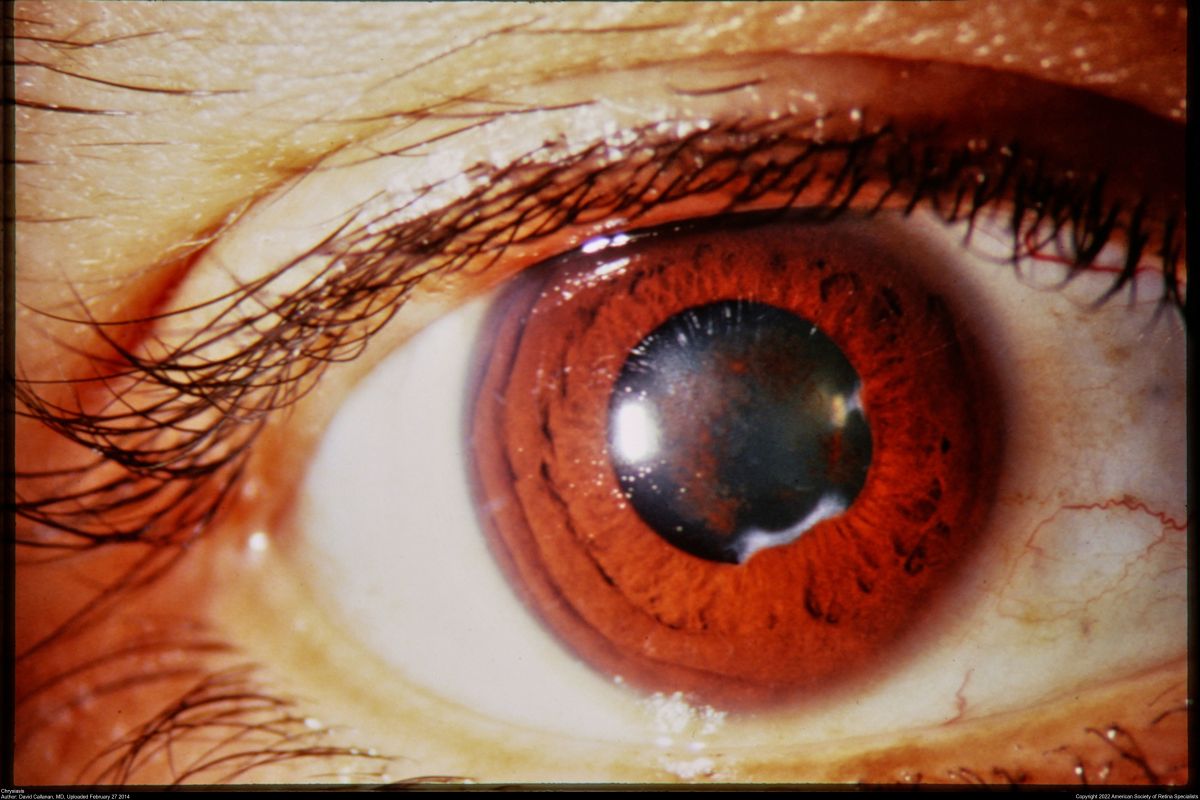 Drug-Induced Corneal Complications - EyeWiki