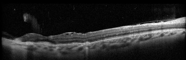 Choroidal Rupture - EyeWiki