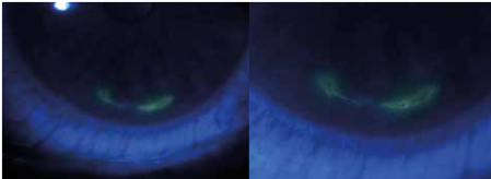 Marginal Keratitis - EyeWiki