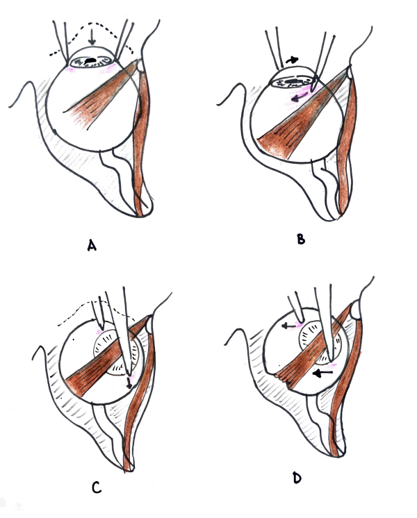 Strabismus Surgery, Cyclovertical - EyeWiki