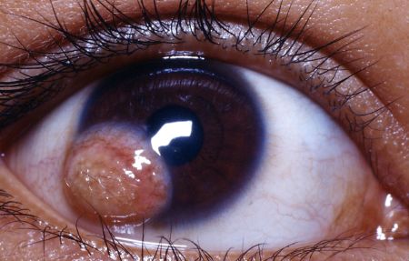 Corneal Dermoid - EyeWiki