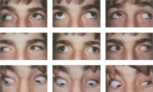 Pattern Strabismus - EyeWiki