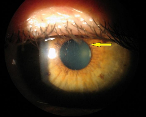 Corneal Inlays - EyeWiki