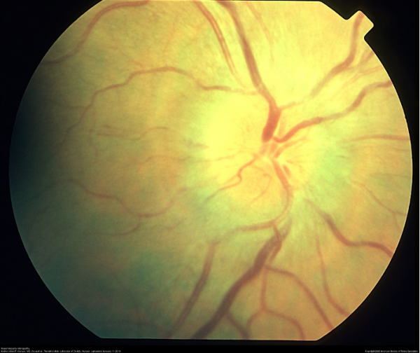 Waldenstrom Macroglobulinemia and Hyperviscosity-related Retinopathy ...