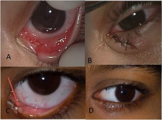Eyelid Reconstruction - EyeWiki