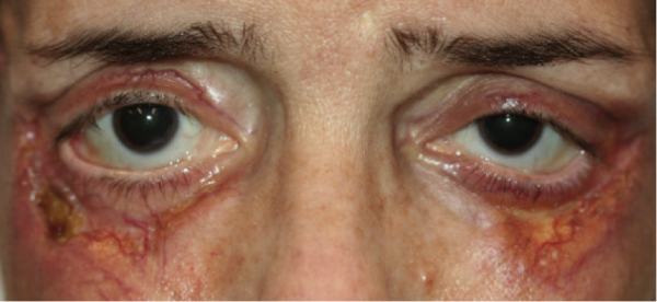 Medial Spindle Procedure - EyeWiki