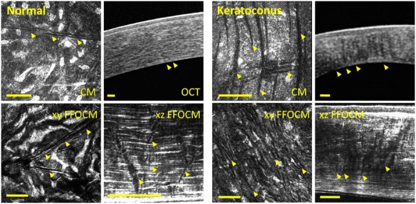 Vogt’s Striae - EyeWiki