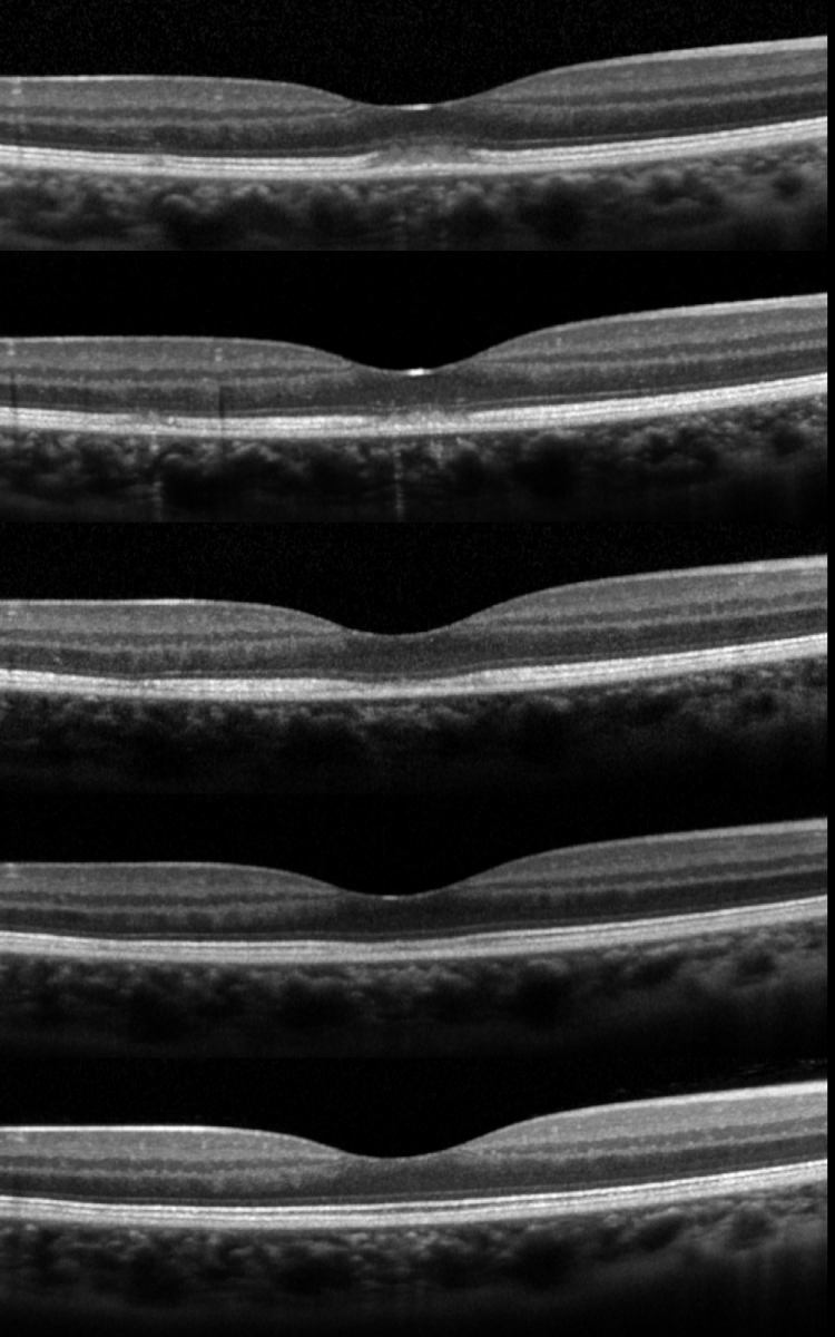 Acute Retinal Pigment Epitheliitis (Krill Disease) - EyeWiki