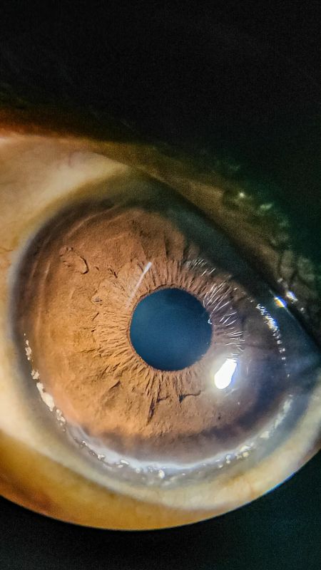 Terrien's Marginal Degeneration - EyeWiki