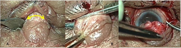 Eyelid Reconstruction - EyeWiki