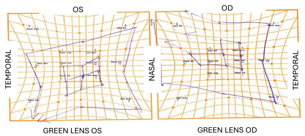 The Hess Test - EyeWiki
