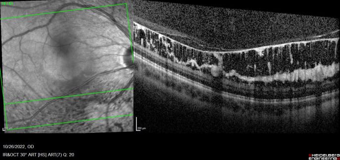 Internal Limiting Membrane Dystrophy (ILMD) - EyeWiki