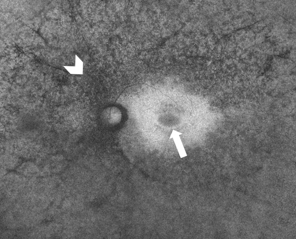 Fundus Autofluorescence - EyeWiki