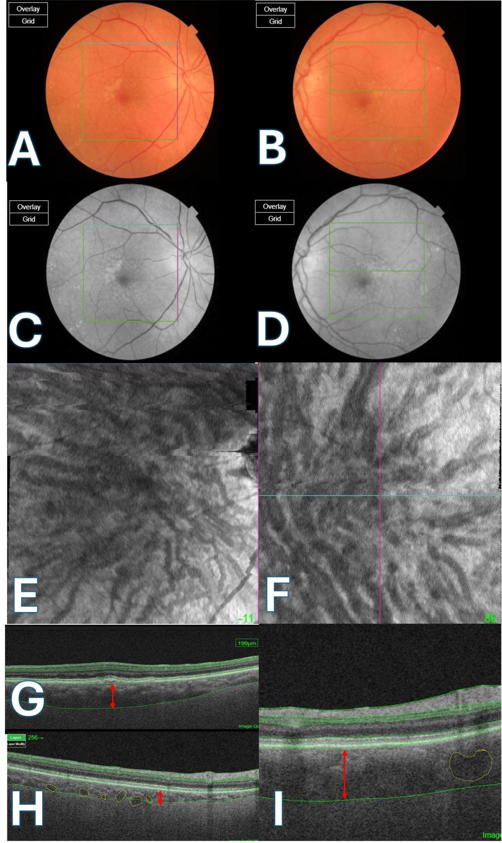 Choroidal Vascular Anomalies: Posterior Vortex Veins, Choroidal ...