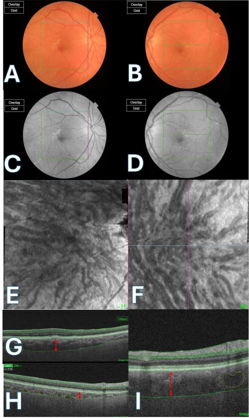 Choroidal Vascular Anomalies: Posterior Vortex Veins, Choroidal ...